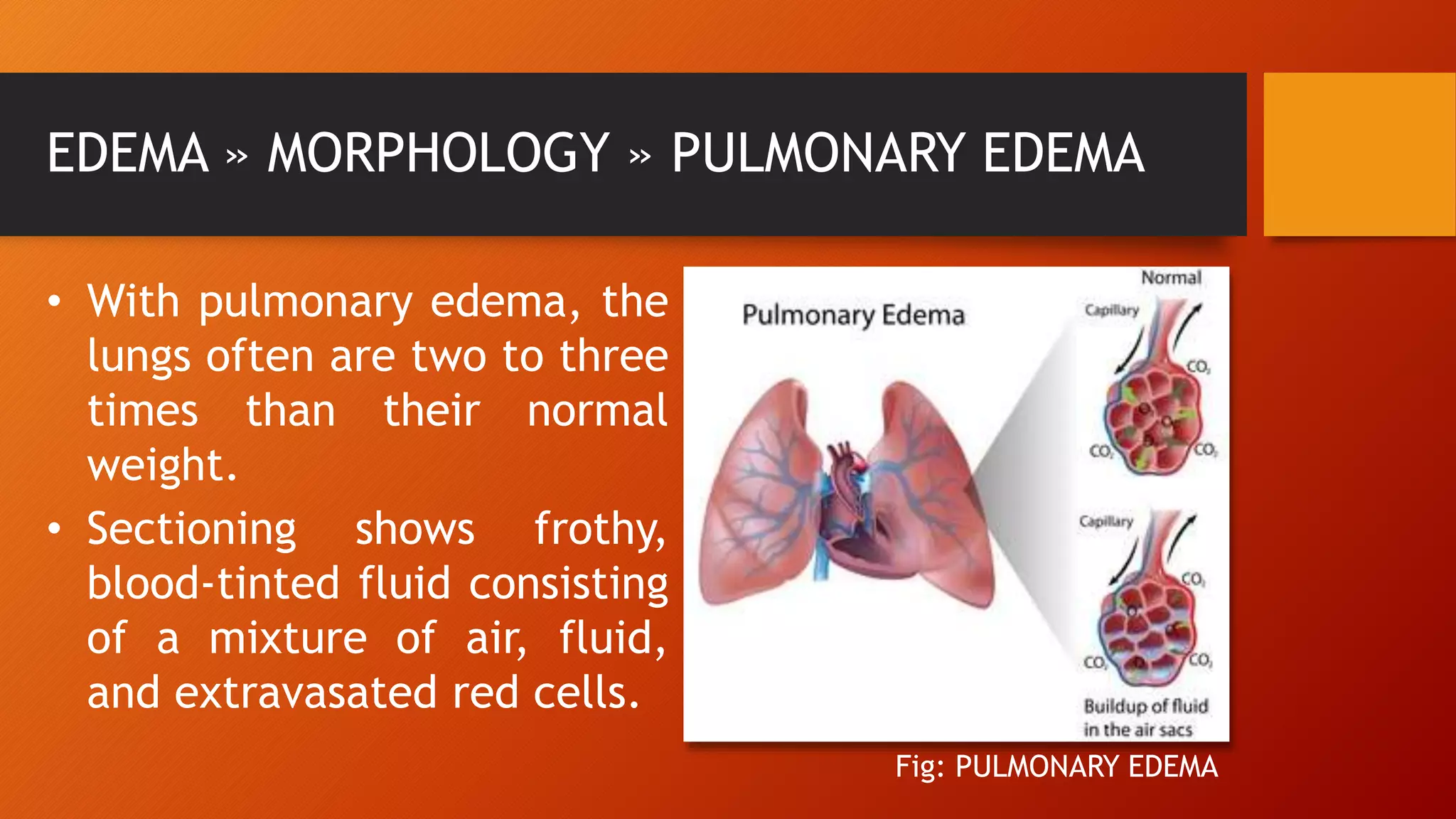 Pathology - Edema.pptx