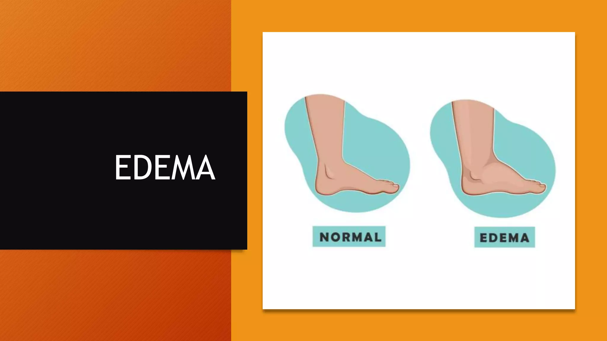 Pathology - Edema.pptx