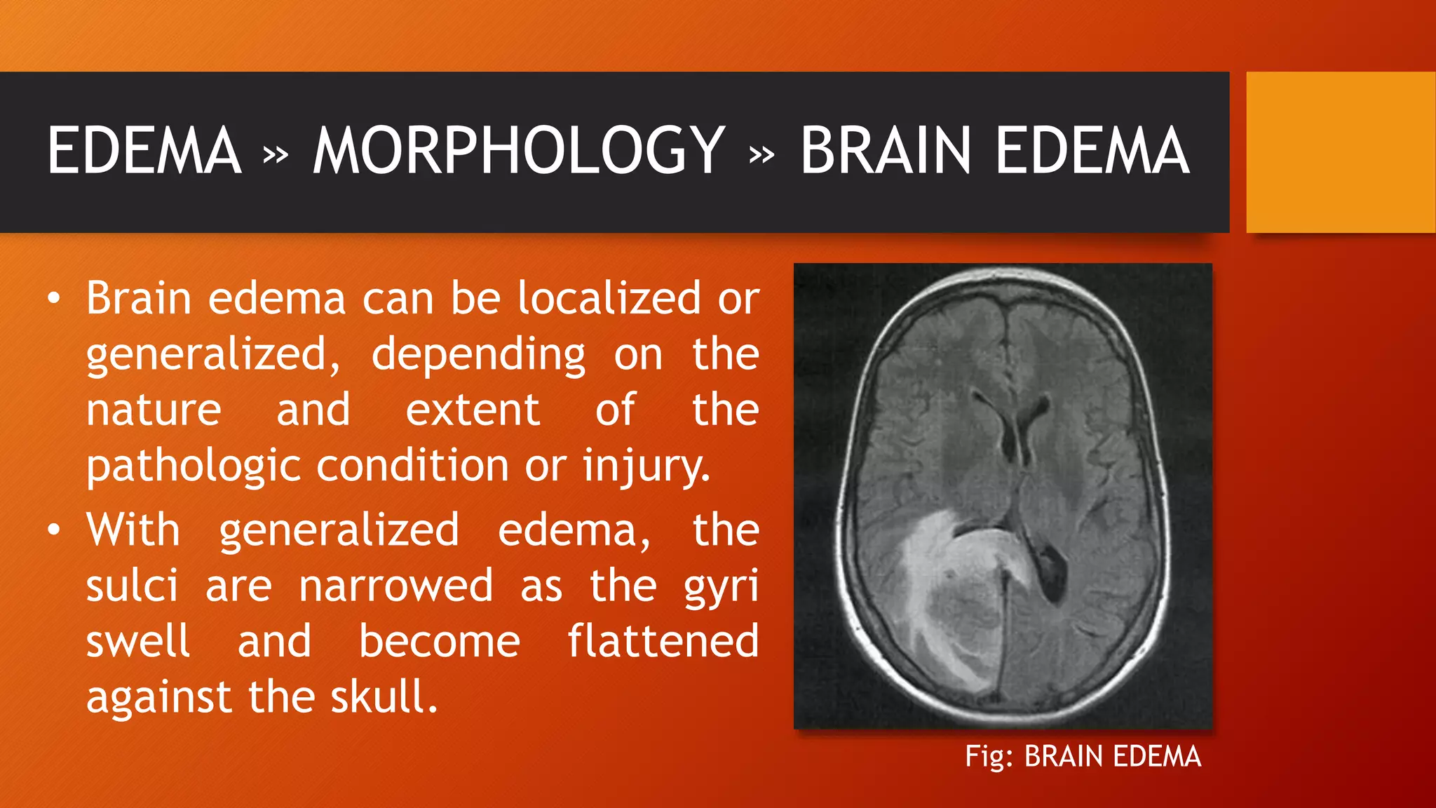 Pathology - Edema.pptx