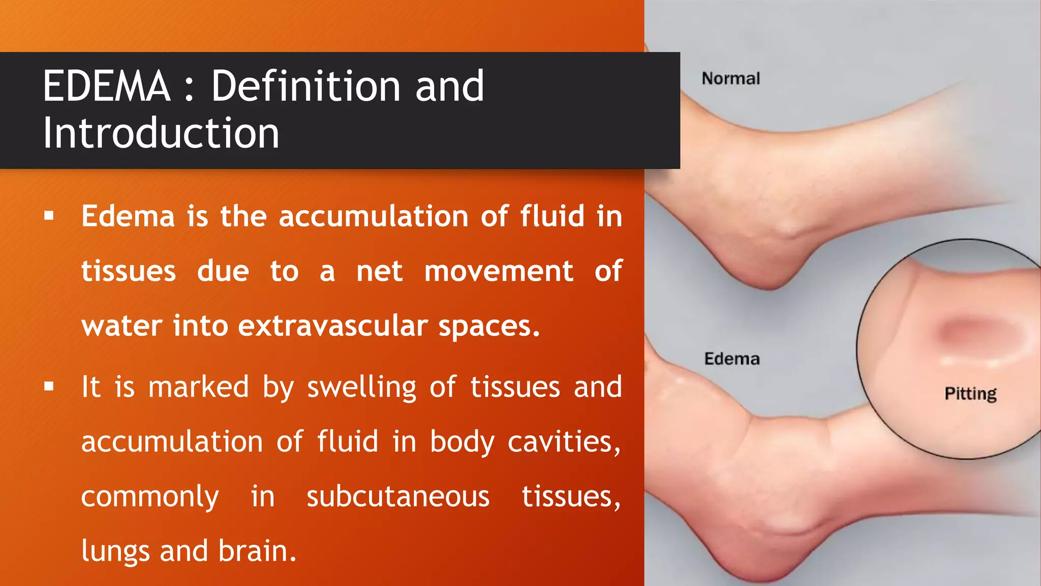 Pathology - Edema.pptx