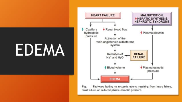 Pathology - Edema.pptx