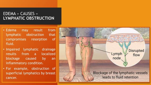Pathology - Edema.pptx