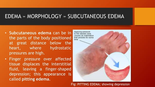 Pathology - Edema.pptx