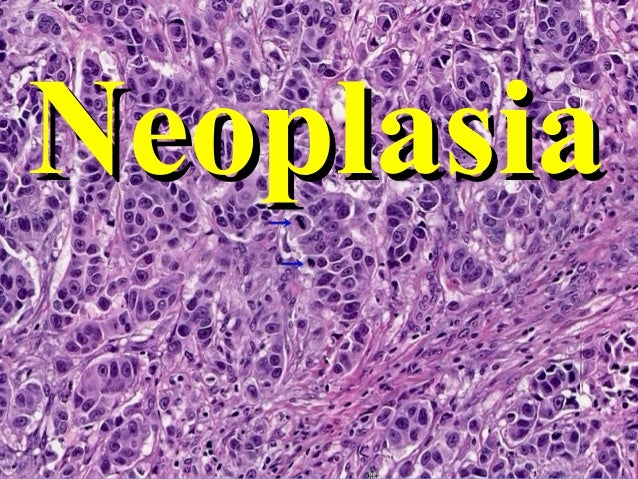 Pathology neoplasm