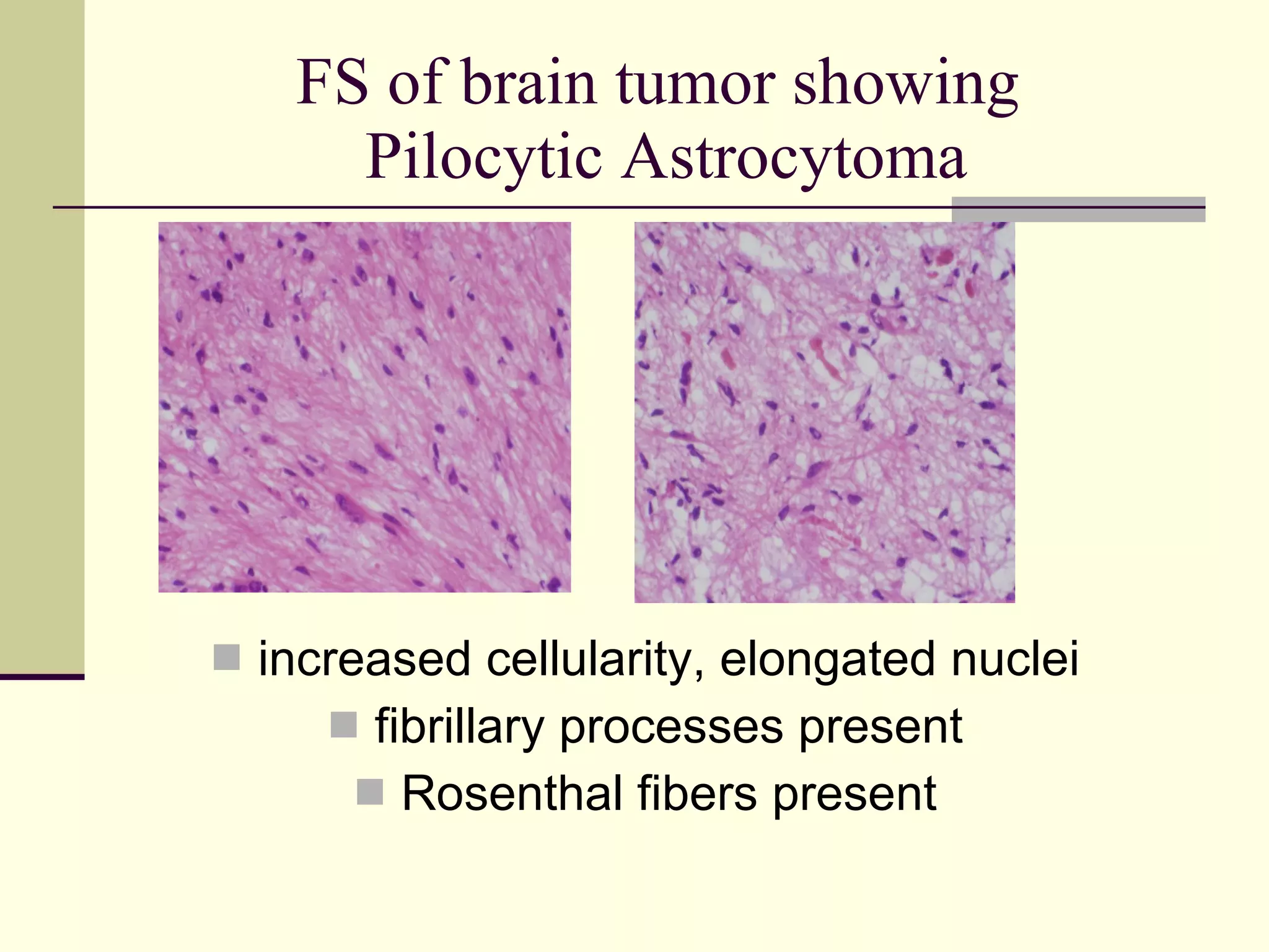 Greig Cephalopolysyndactyly Syndrome | PPT