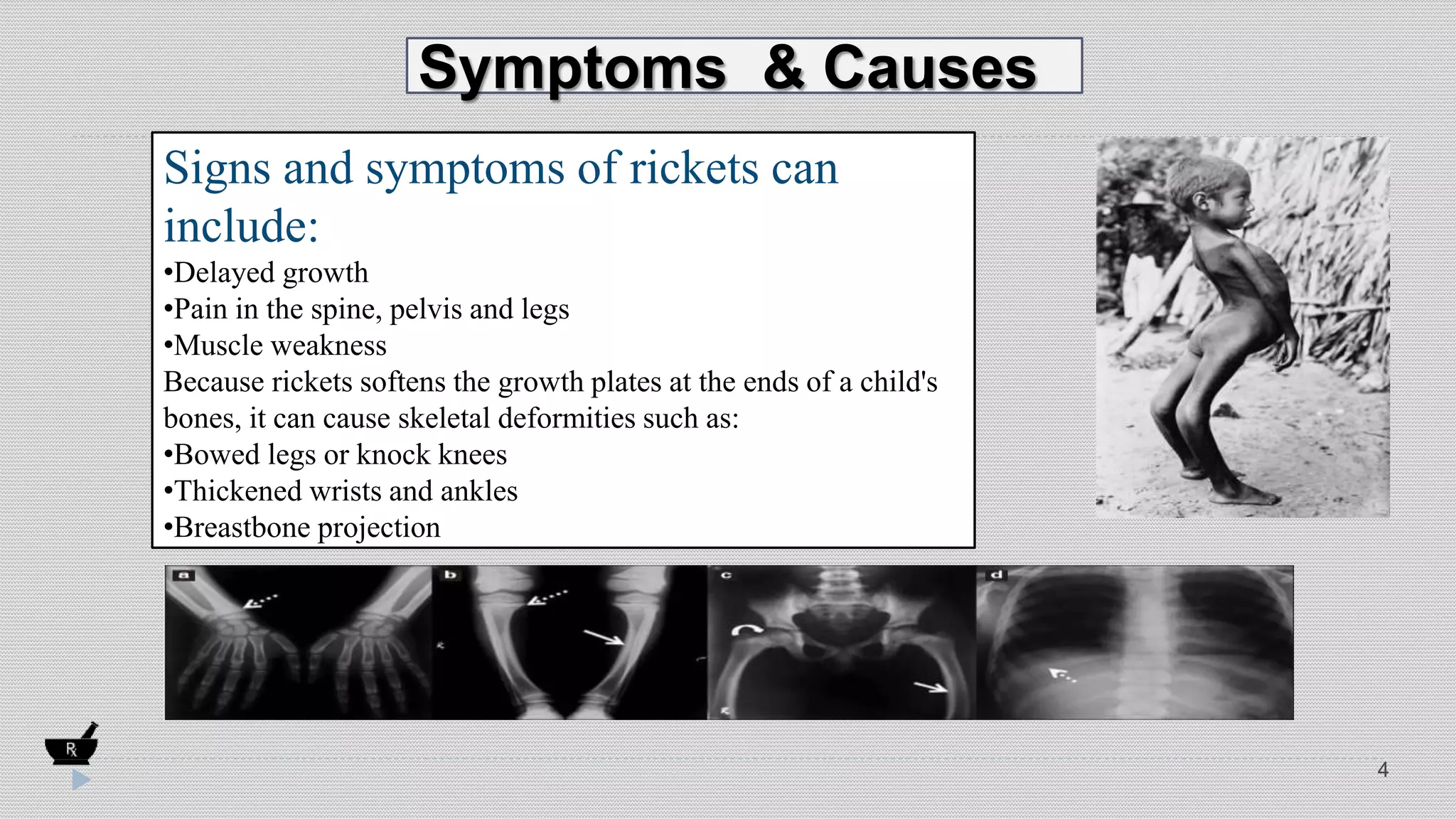 Rickets | PPT