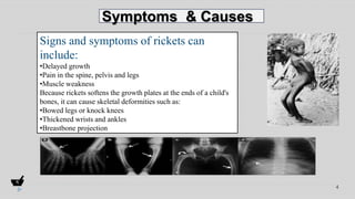 Rickets | PPTX