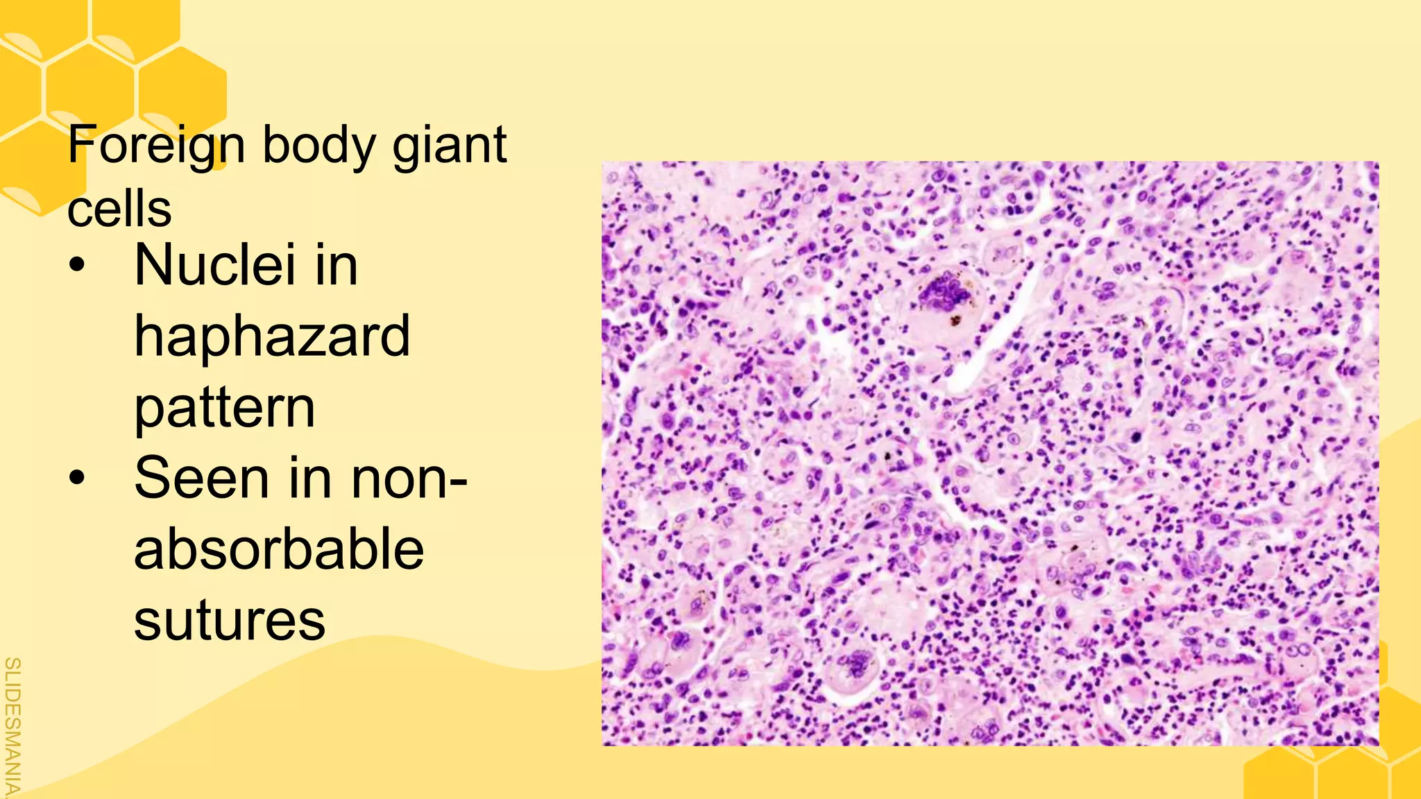 chronic inflammation | PPTX