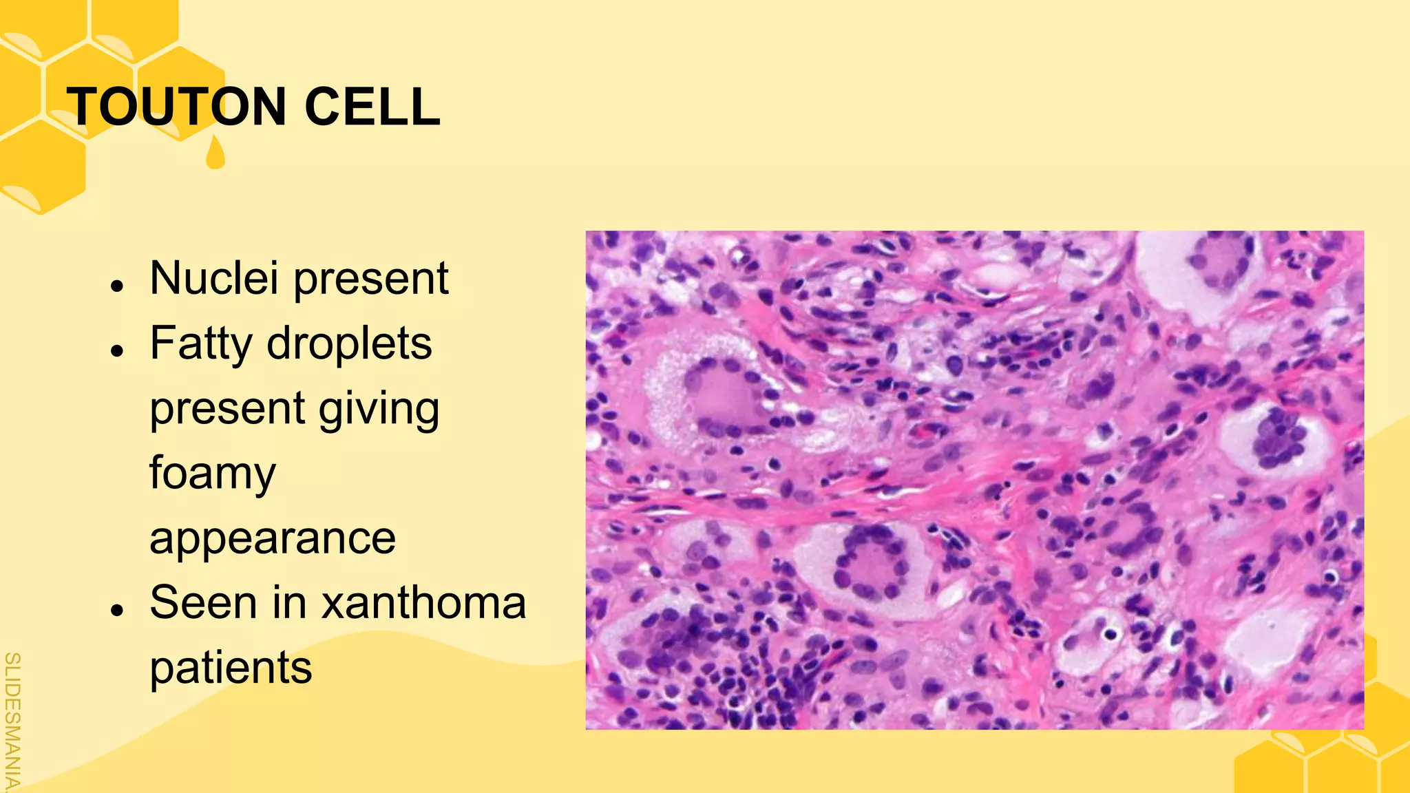 chronic inflammation | PPTX