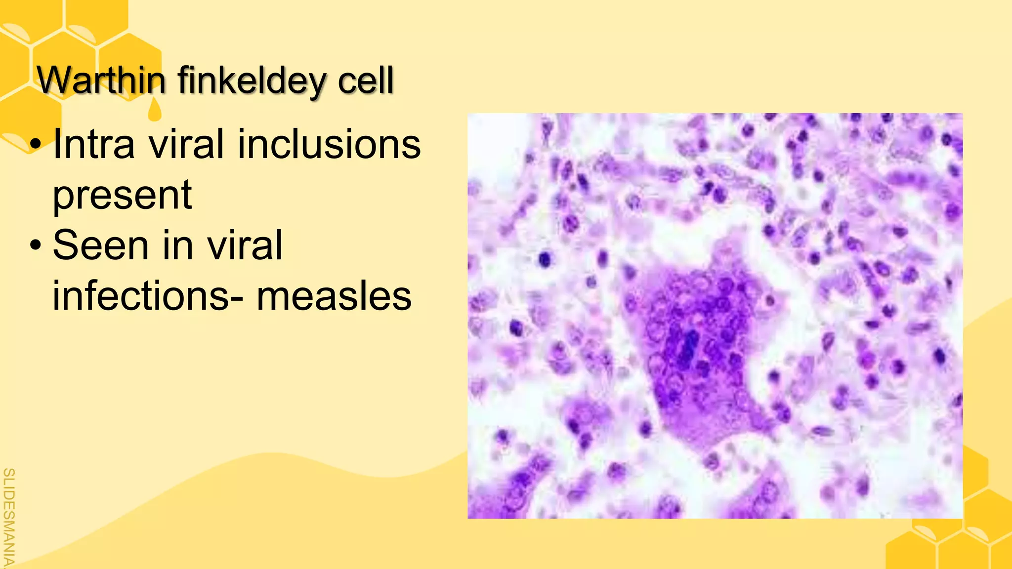 chronic inflammation | PPTX
