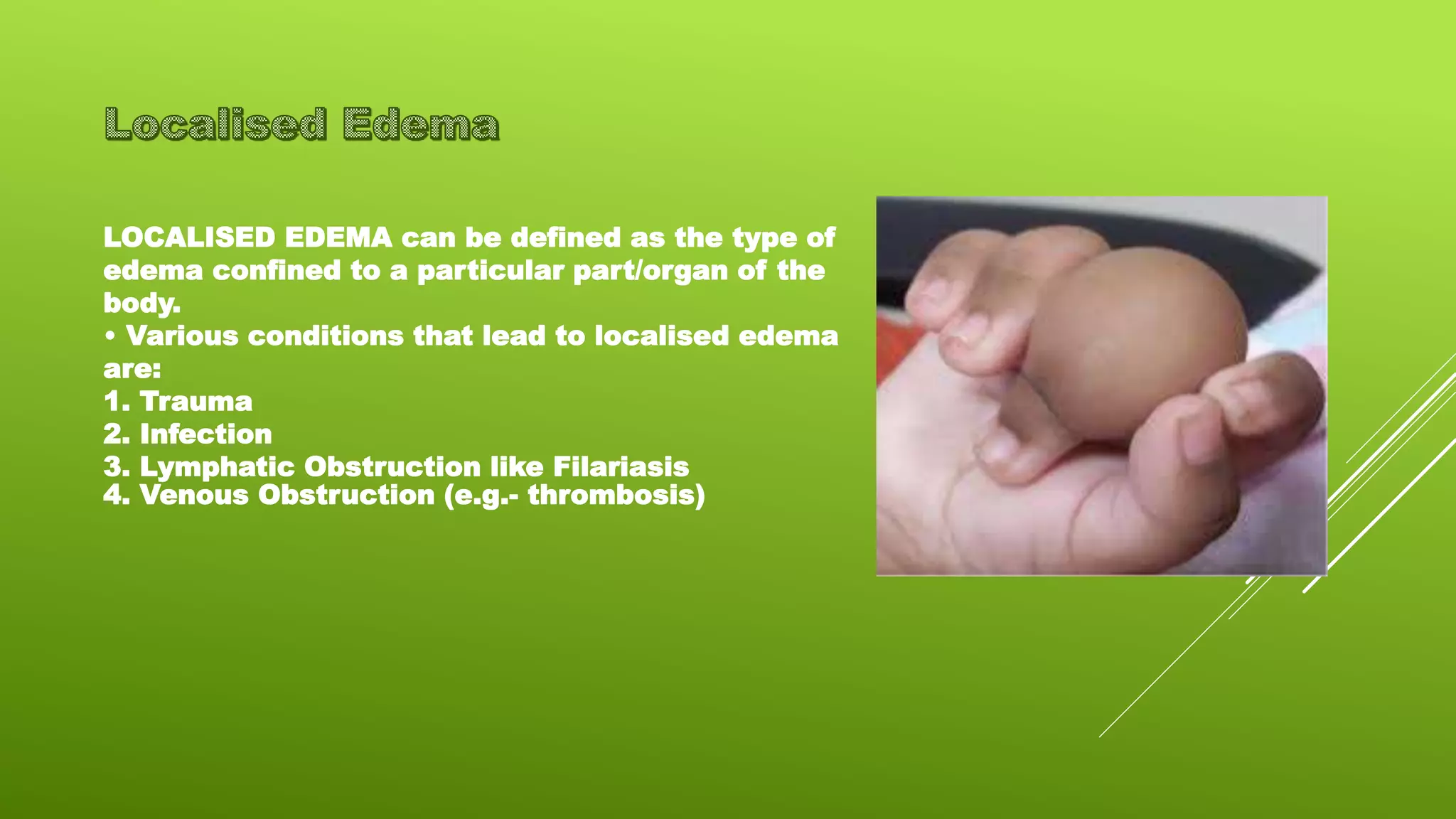 edema pathology | PPTX