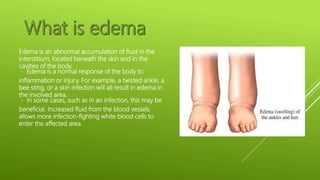 edema pathology | PPTX