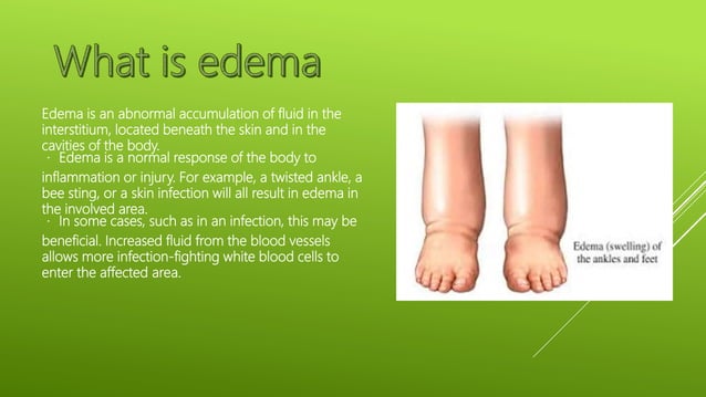edema pathology | PPTX
