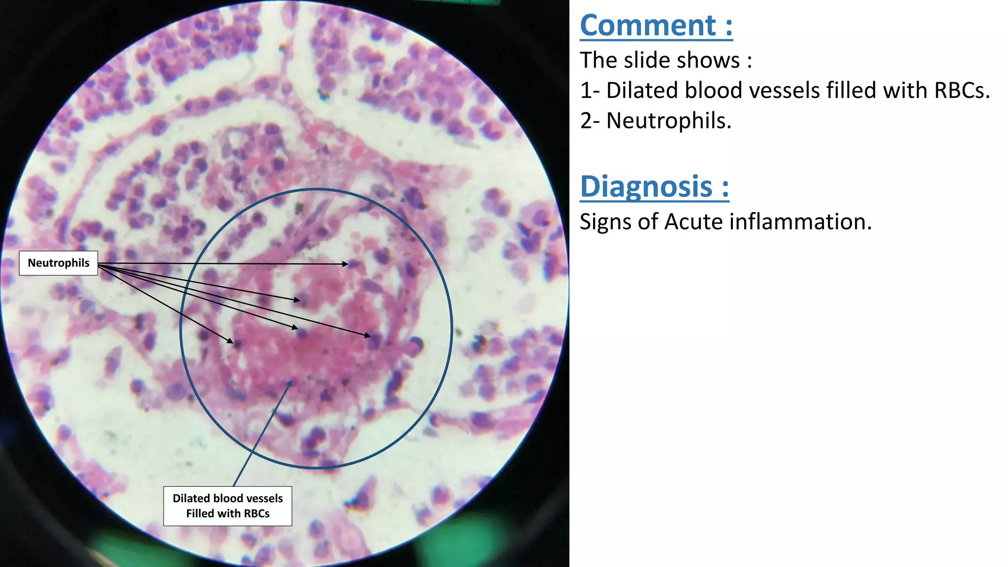 Pathology (acute inflammation) | PDF