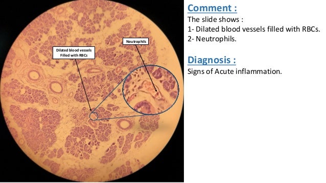 Pathology (acute inflammation)