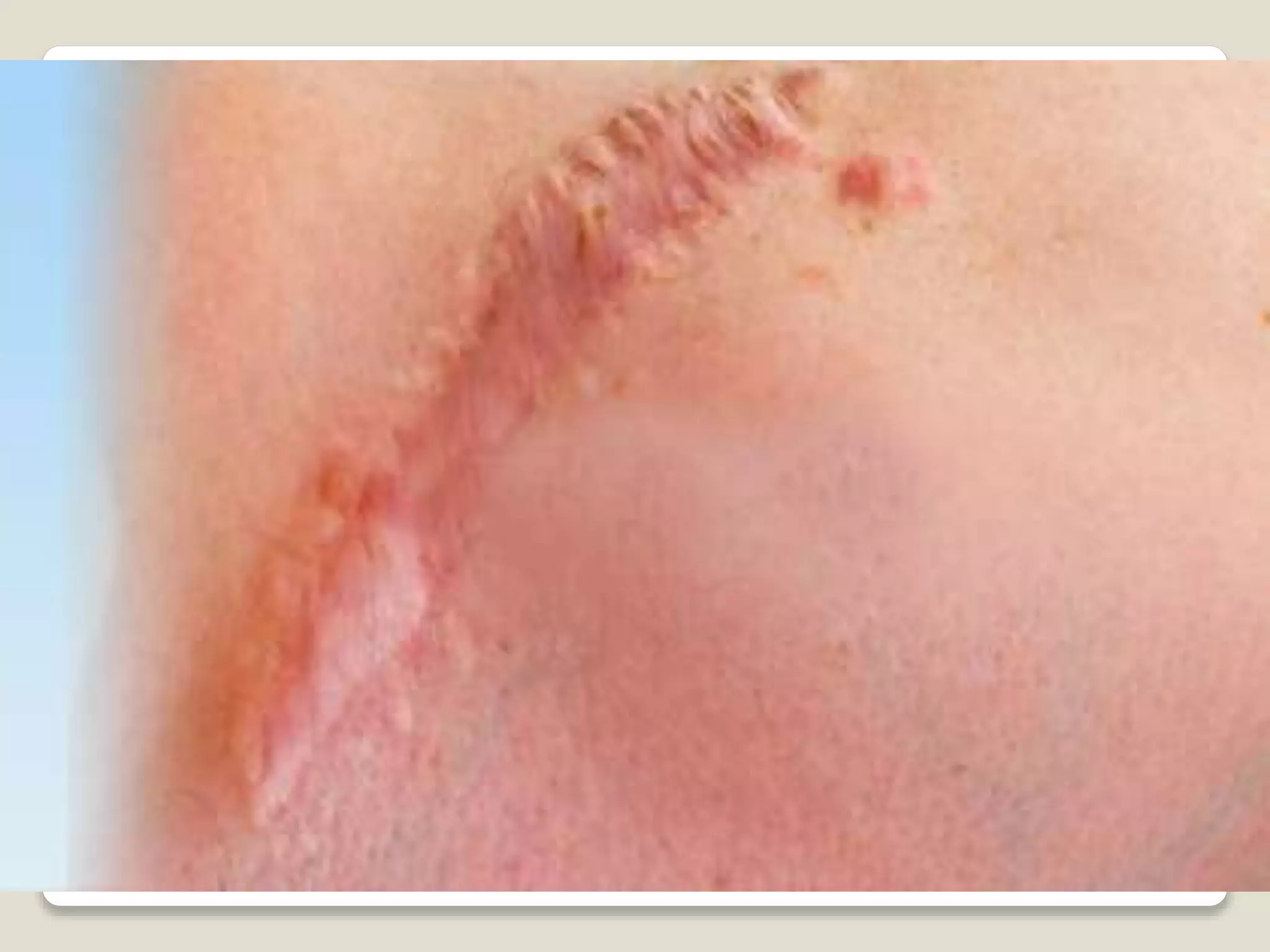 Pathology (keloid of abdominal) | PPTX