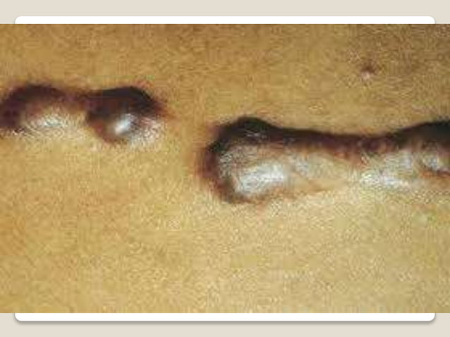 Pathology (keloid of abdominal) | PPT