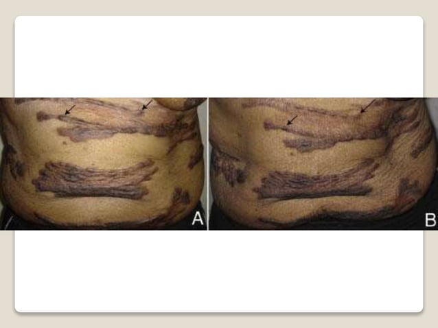 Pathology (keloid of abdominal) | PPT