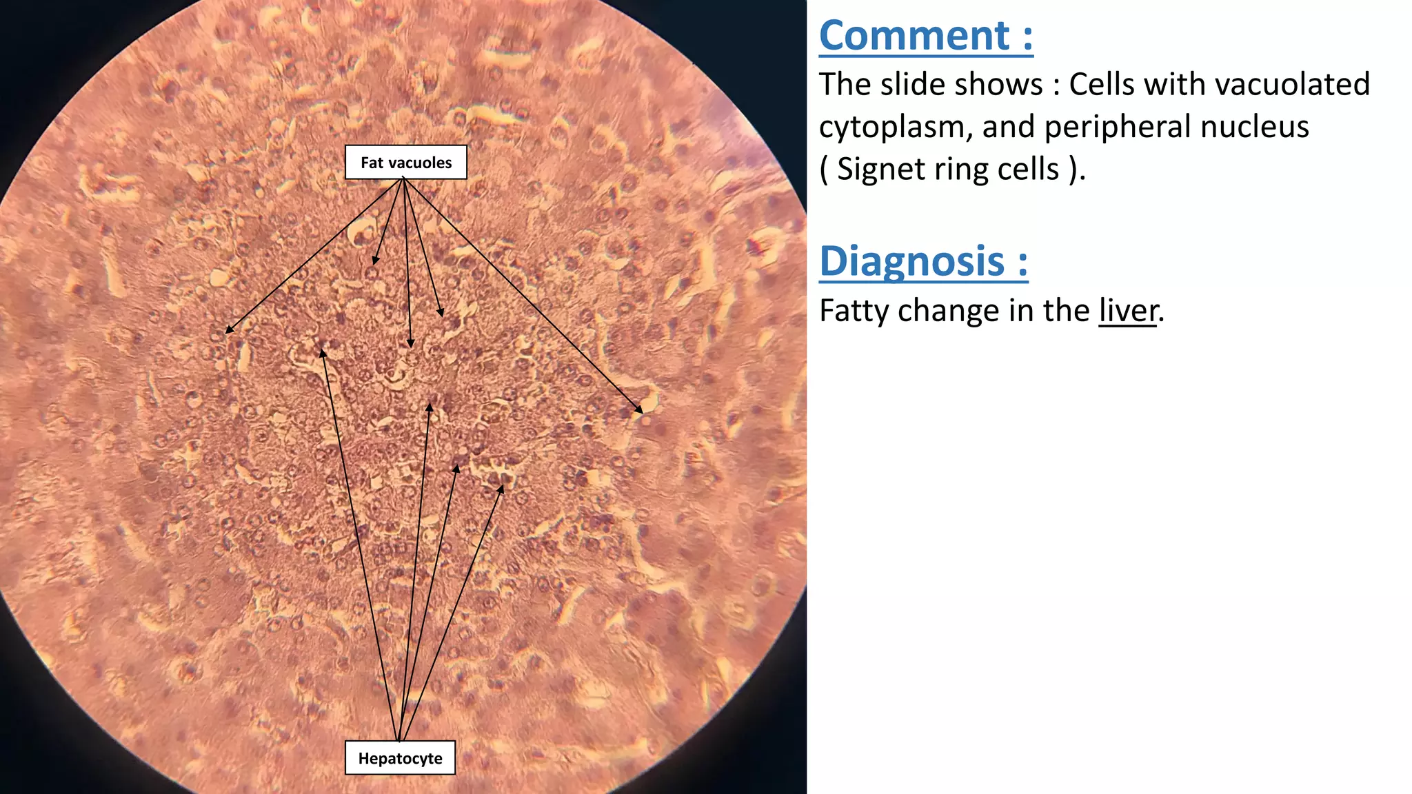 Pathology (cell adaptation) | PDF