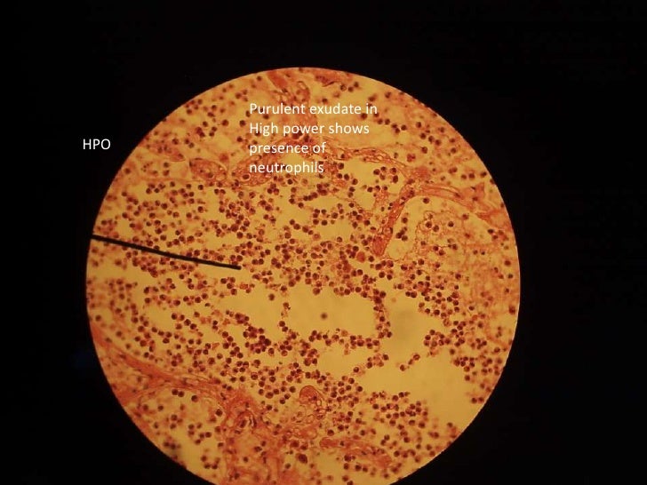 Proteinaceous Exudate