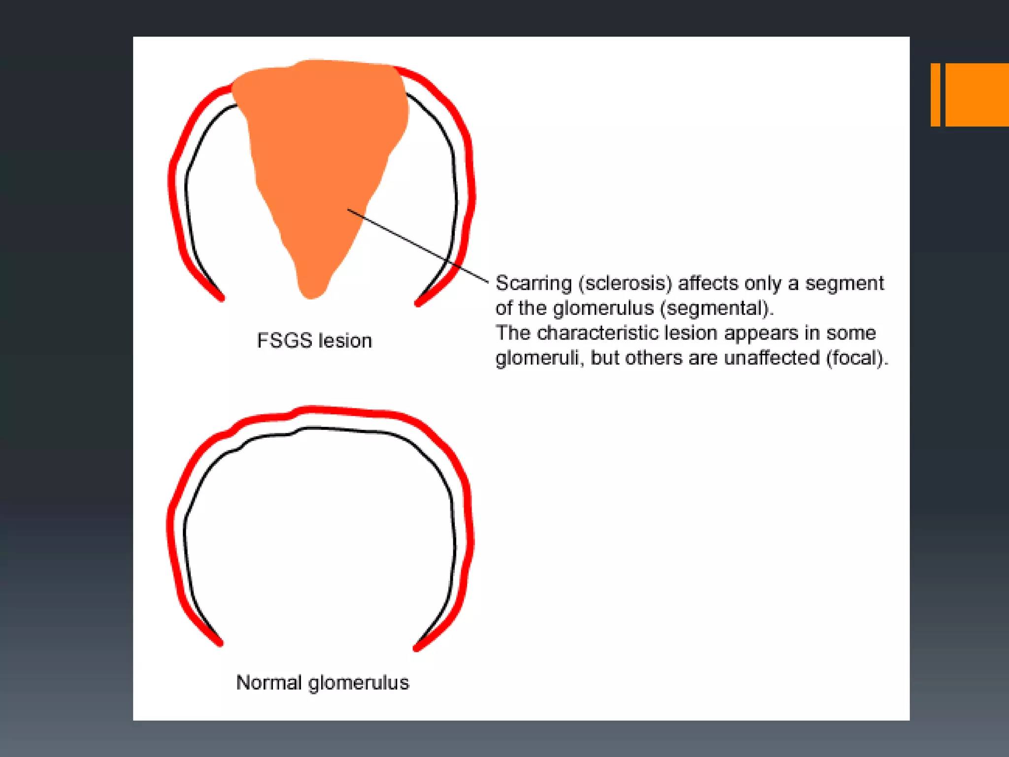 Focal Segmental Glomerulosclerosis - Pathology - FSGS | PPTX