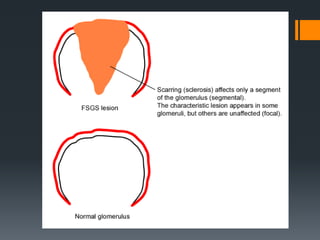 Focal Segmental Glomerulosclerosis - Pathology - FSGS | PPTX