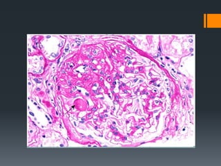 Focal Segmental Glomerulosclerosis - Pathology - FSGS | PPTX