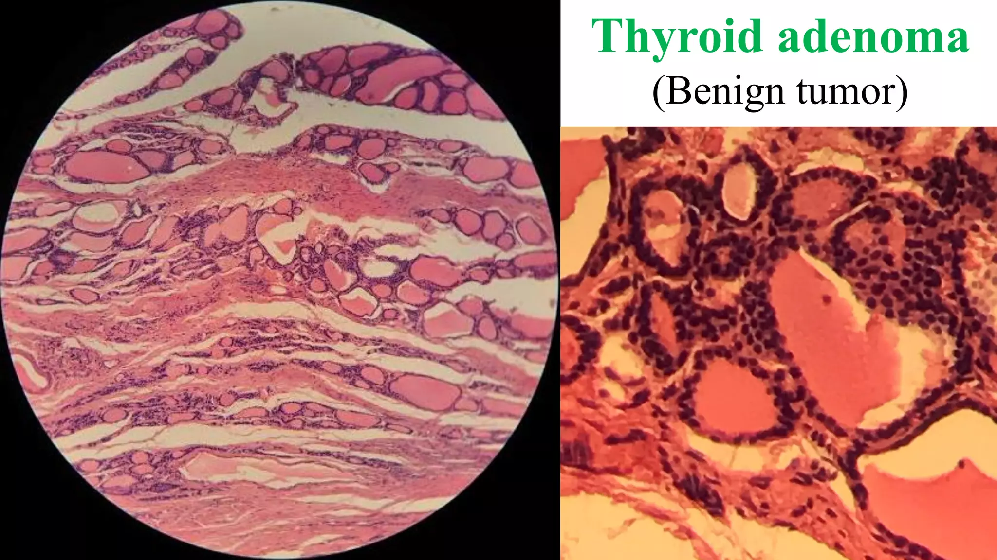 Pathology (growth characters of tumor) | PDF