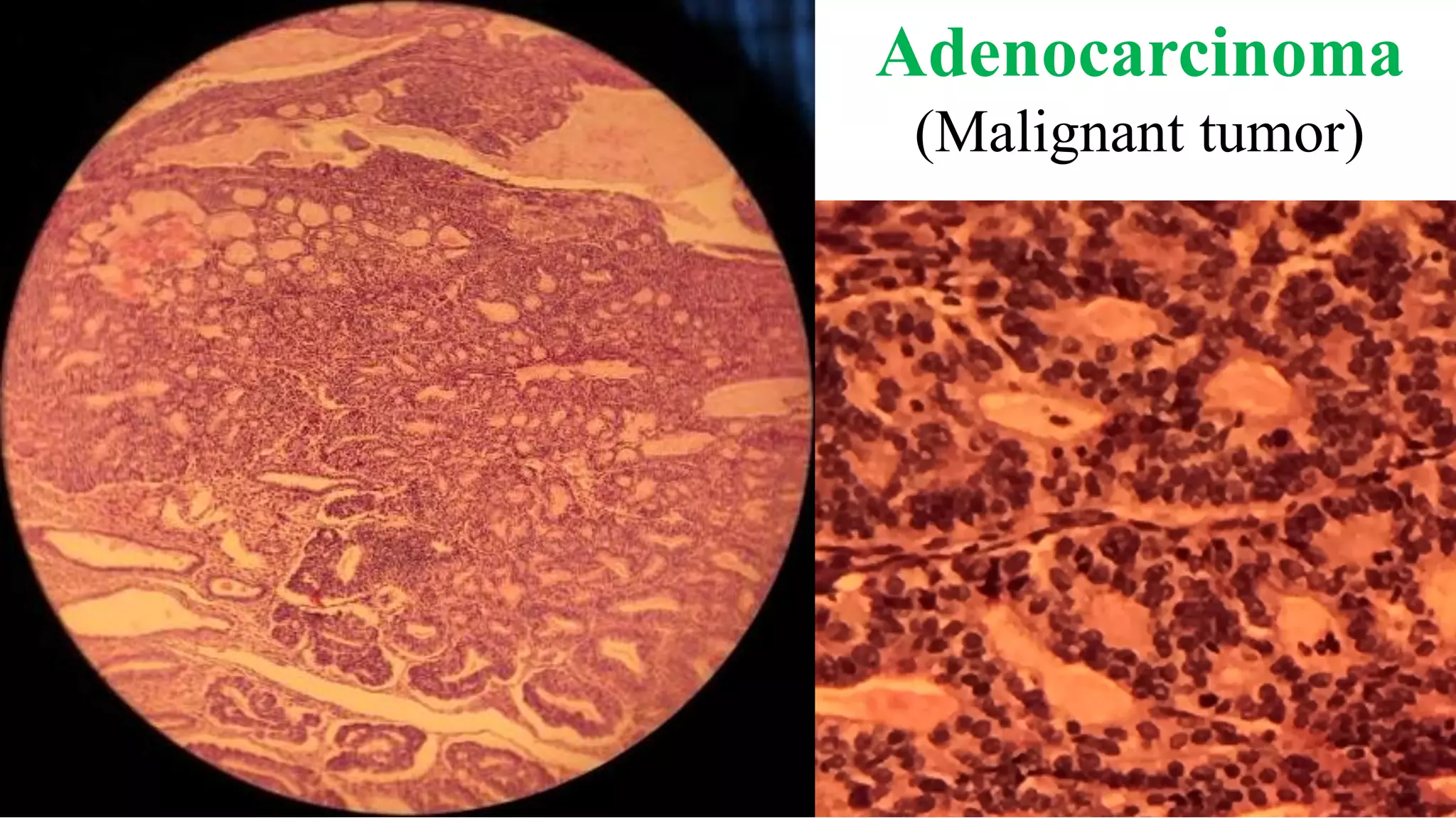 Pathology (growth characters of tumor) | PDF