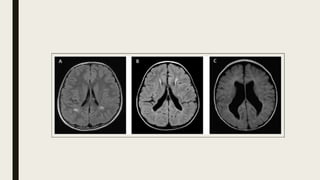Pathology in CVI | PPT