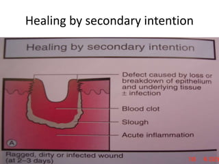Pathology lab 6 the natural history of acute inflammation | PPT