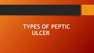 Gastric ulcer | PPTX