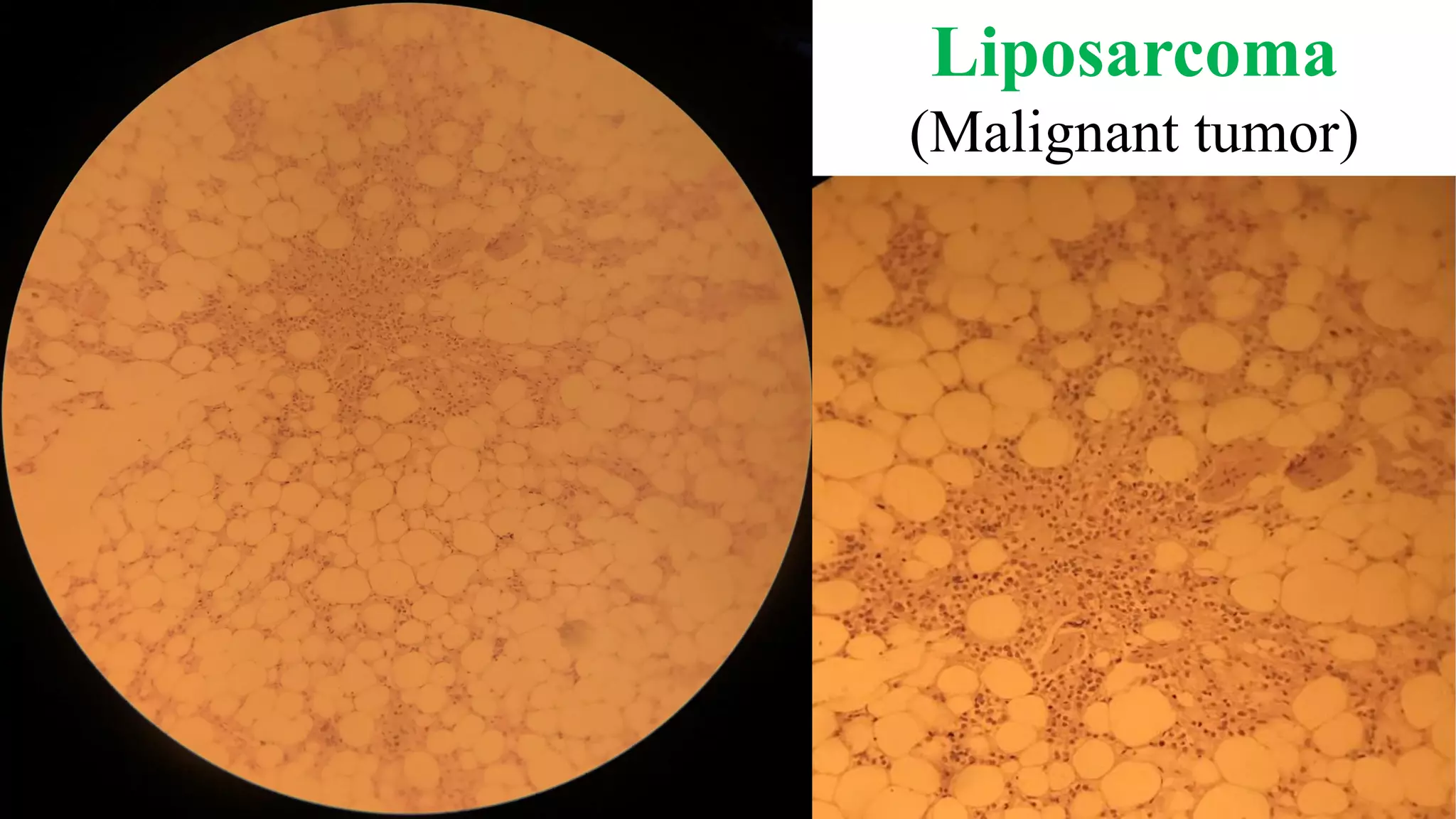 Pathology (microscopic feature of some tumors) | PDF