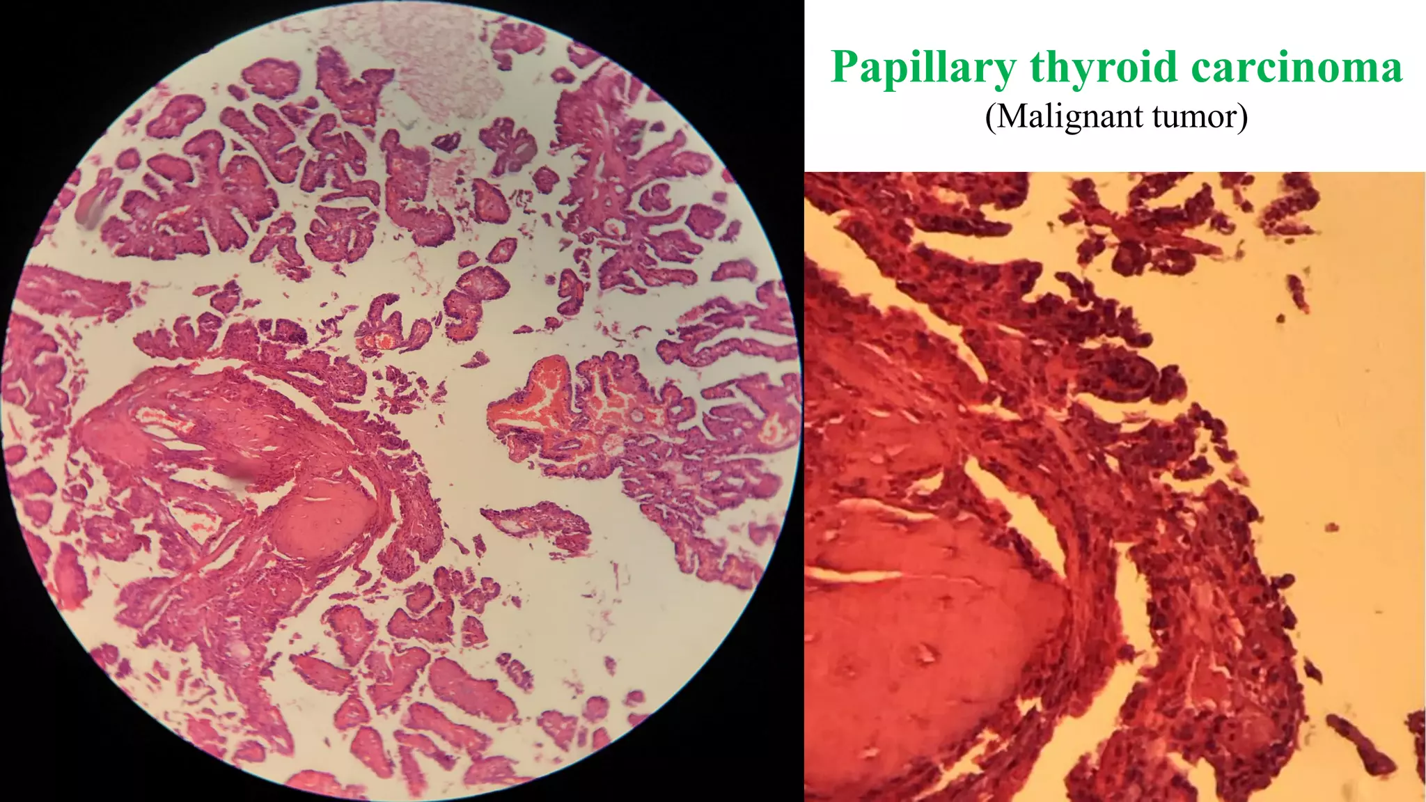 Pathology (microscopic feature of some tumors) | PDF