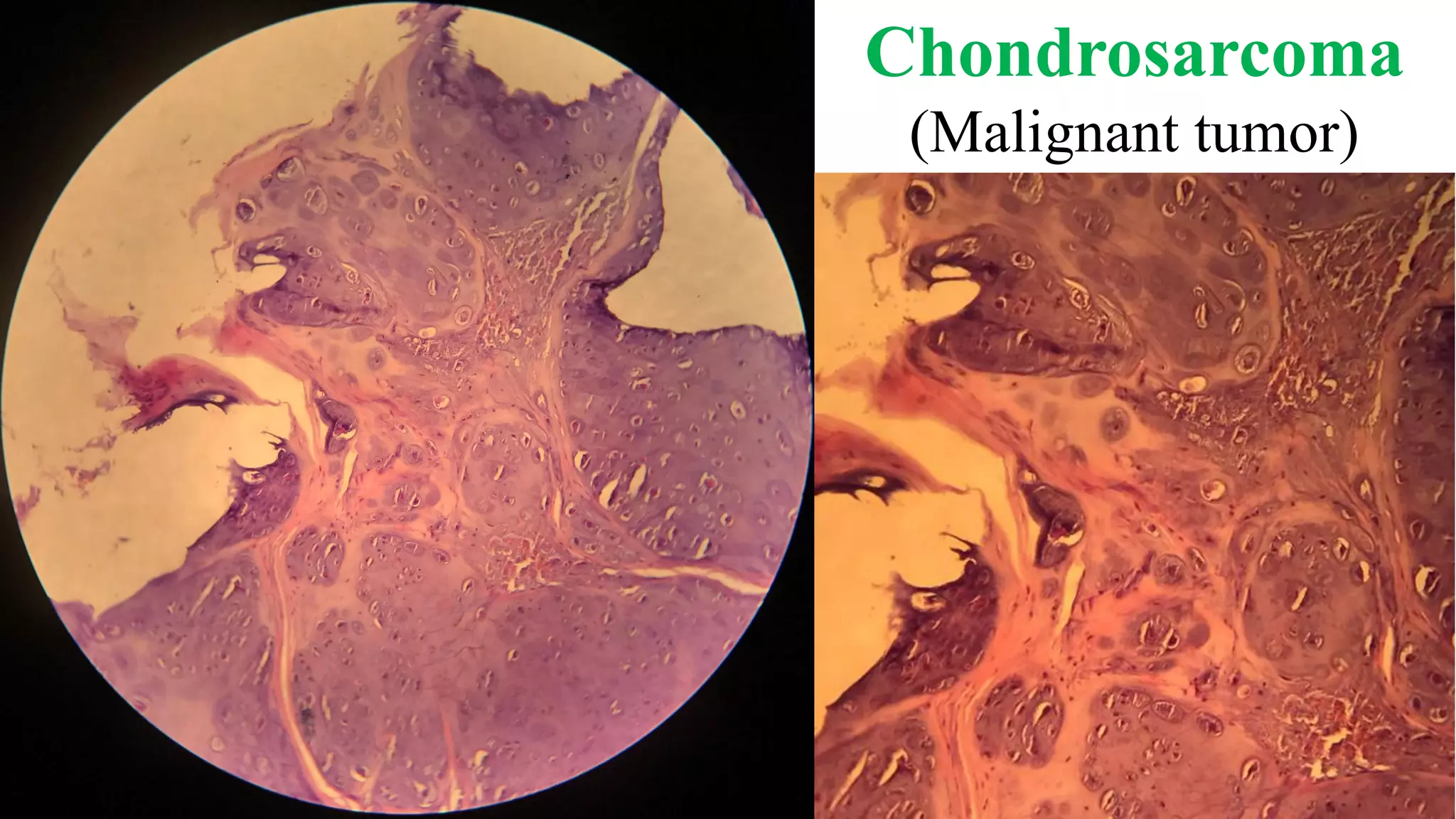 Pathology (microscopic feature of some tumors) | PDF