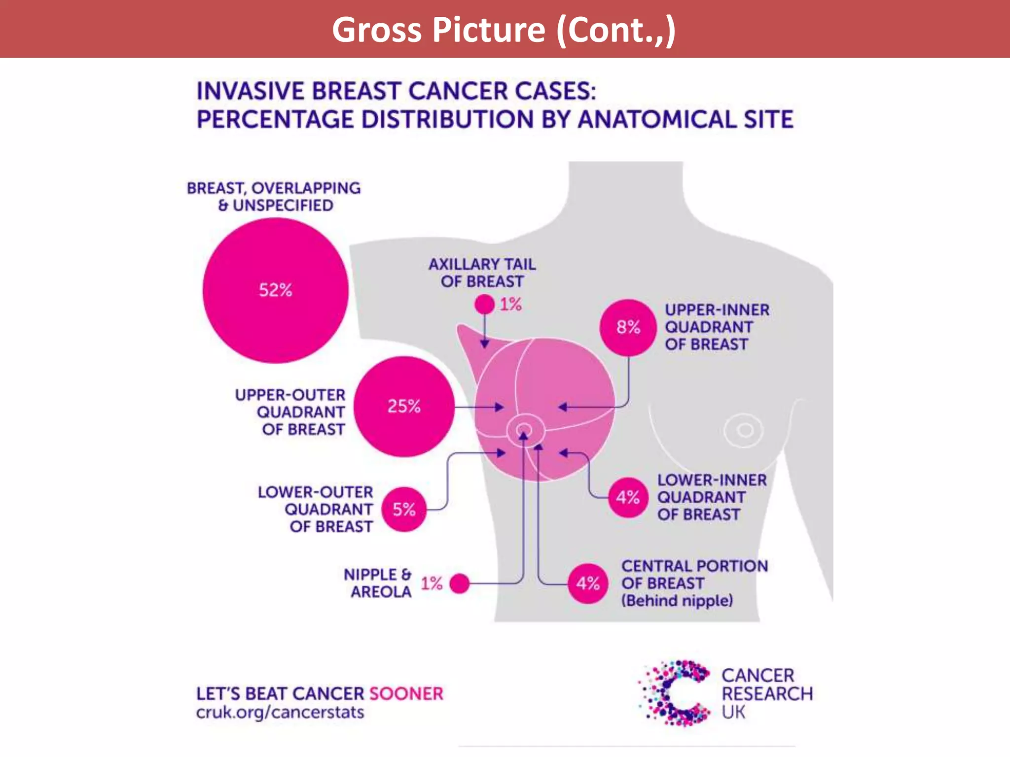 Pathology of breast cancer | PPTX