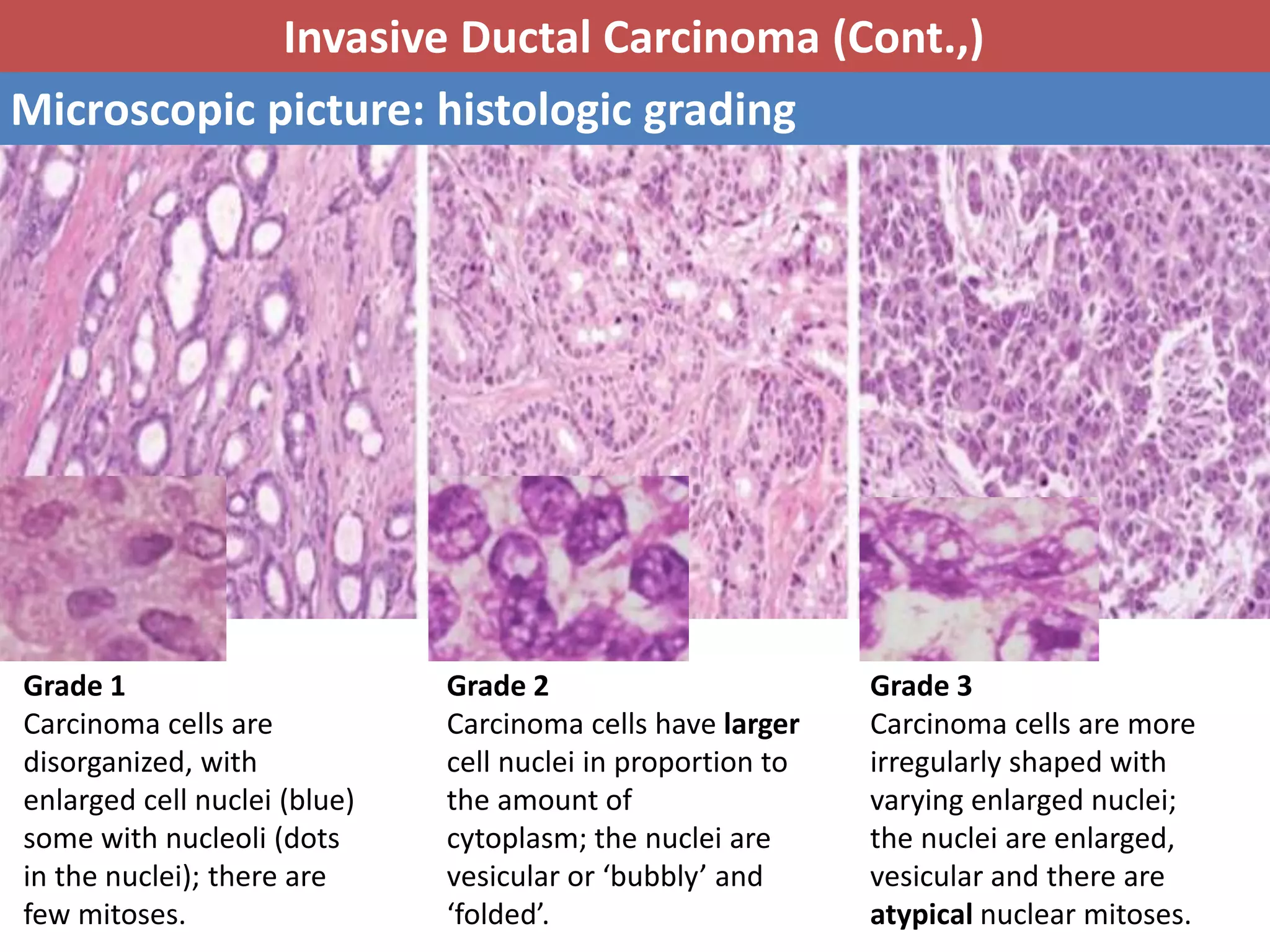 Pathology of breast cancer | PPTX