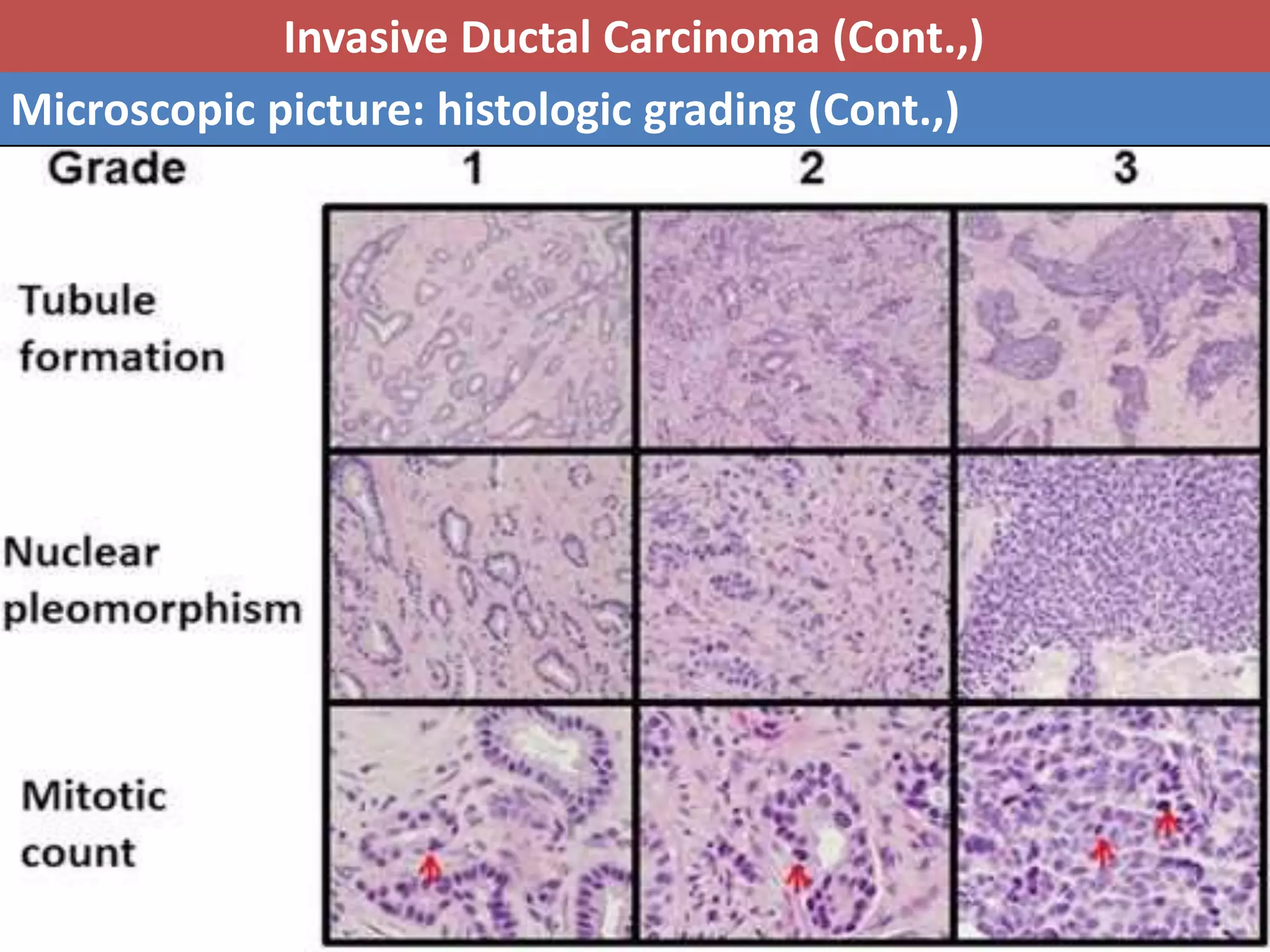 Pathology of breast cancer | PPTX