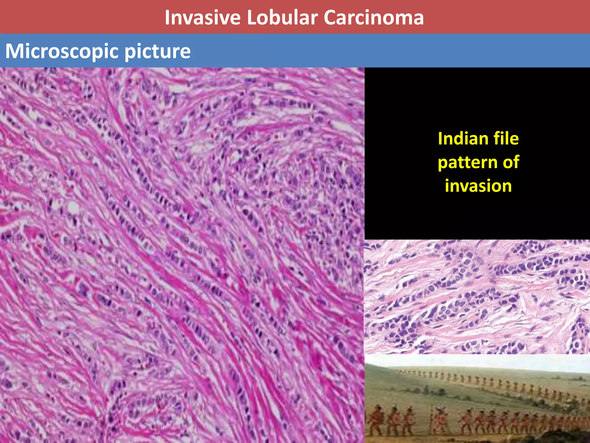 Pathology of breast cancer | PPTX