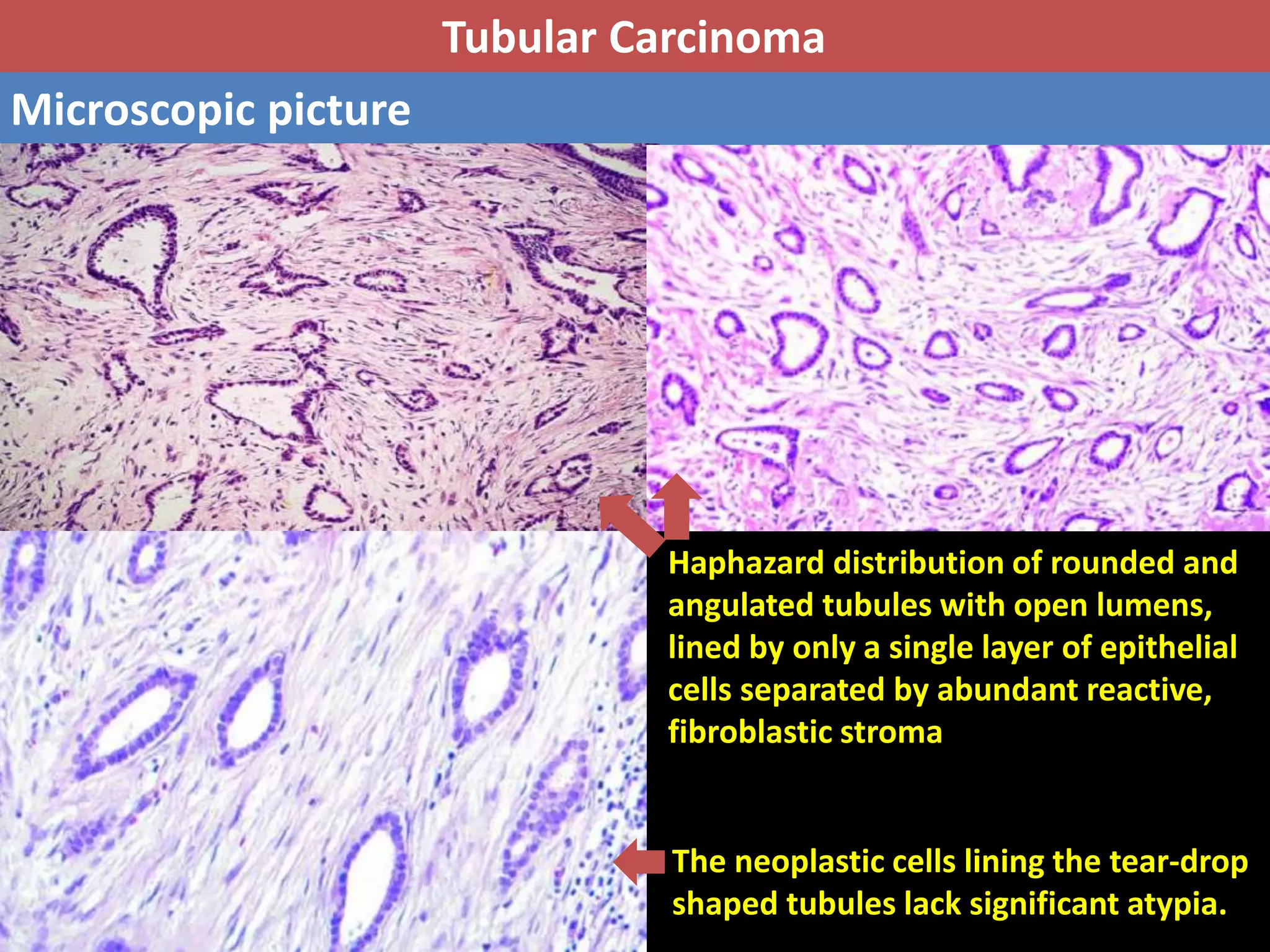 Pathology of breast cancer | PPTX