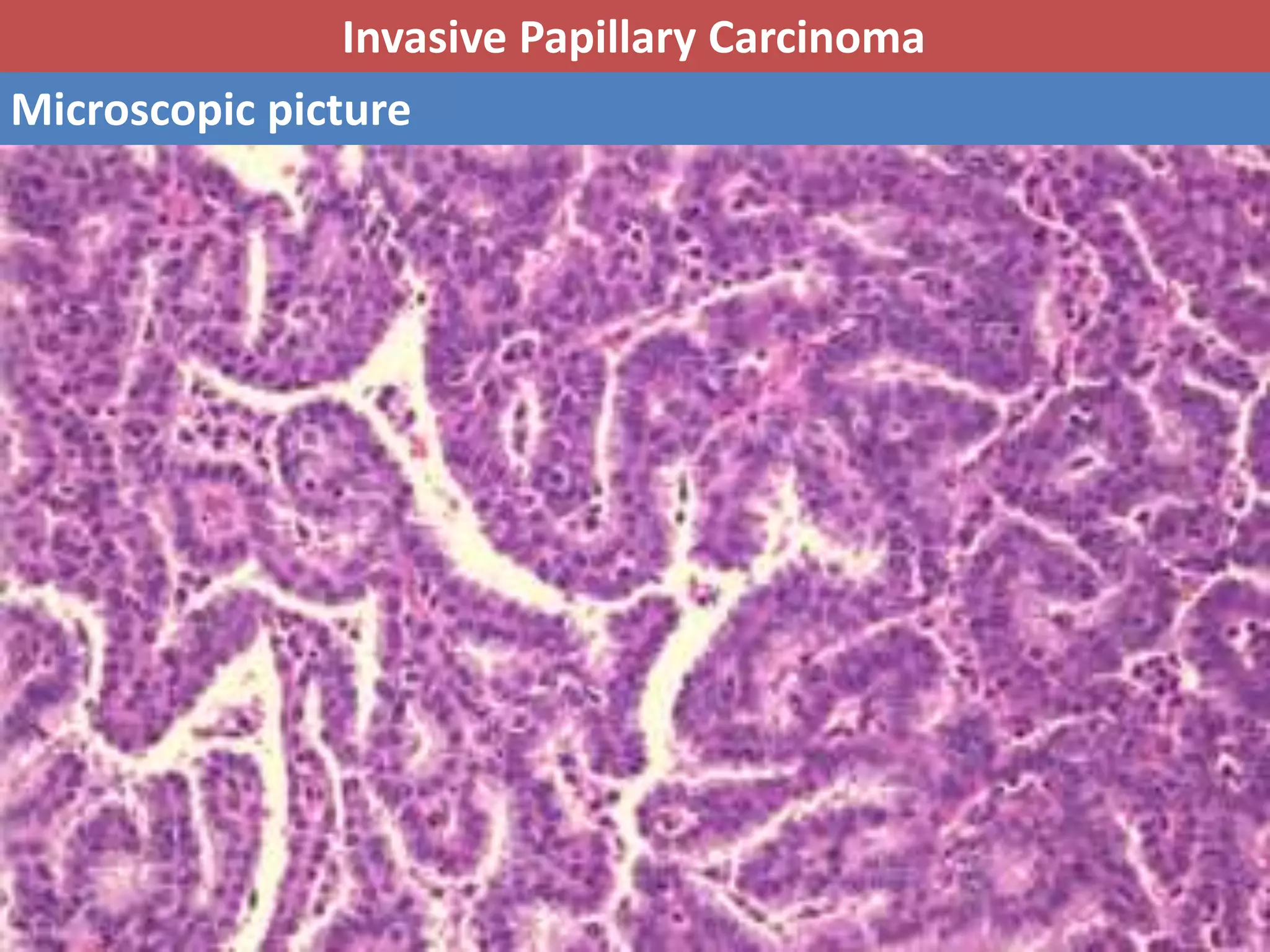Pathology of breast cancer | PPTX