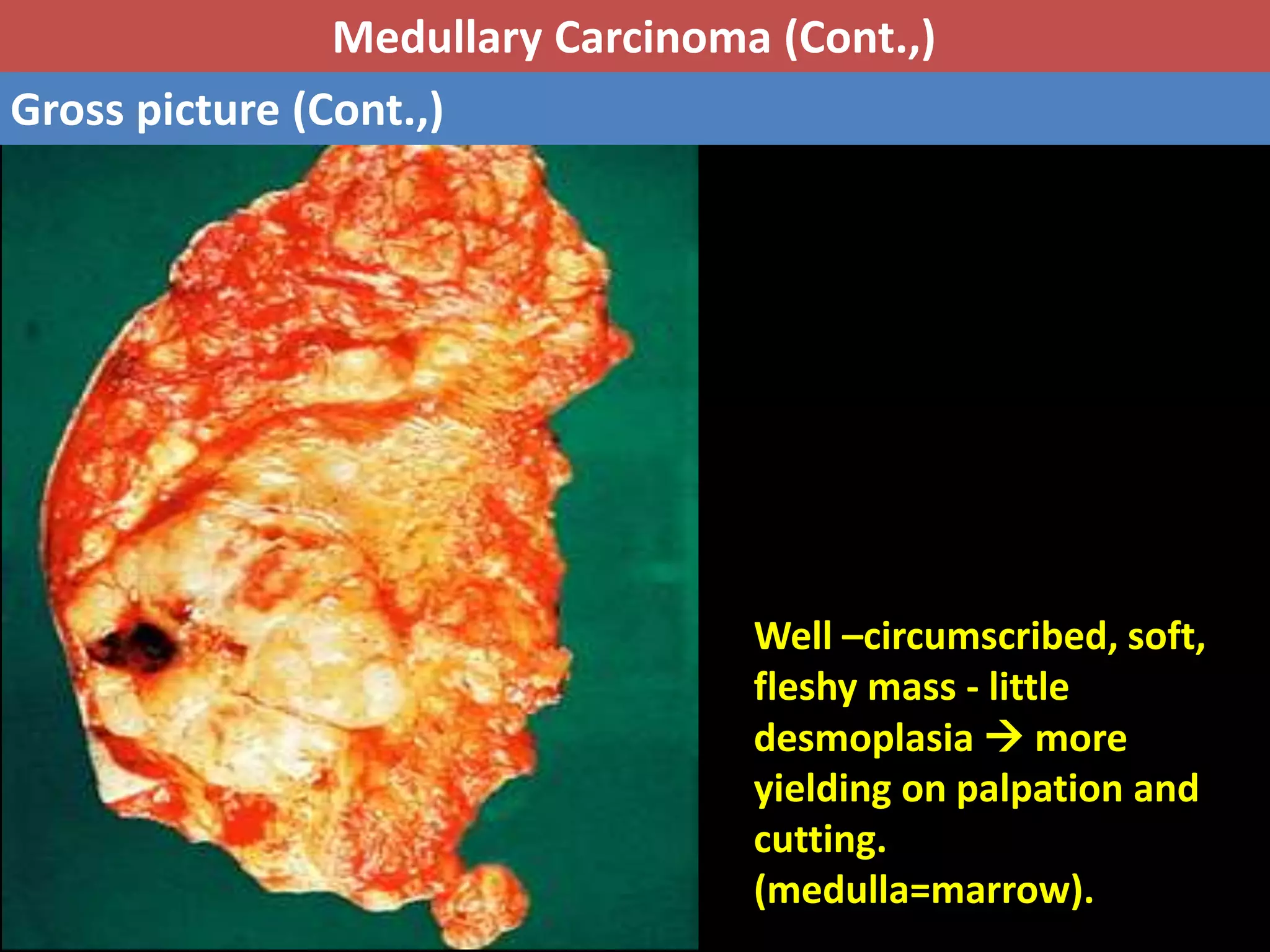 Pathology of breast cancer | PPTX