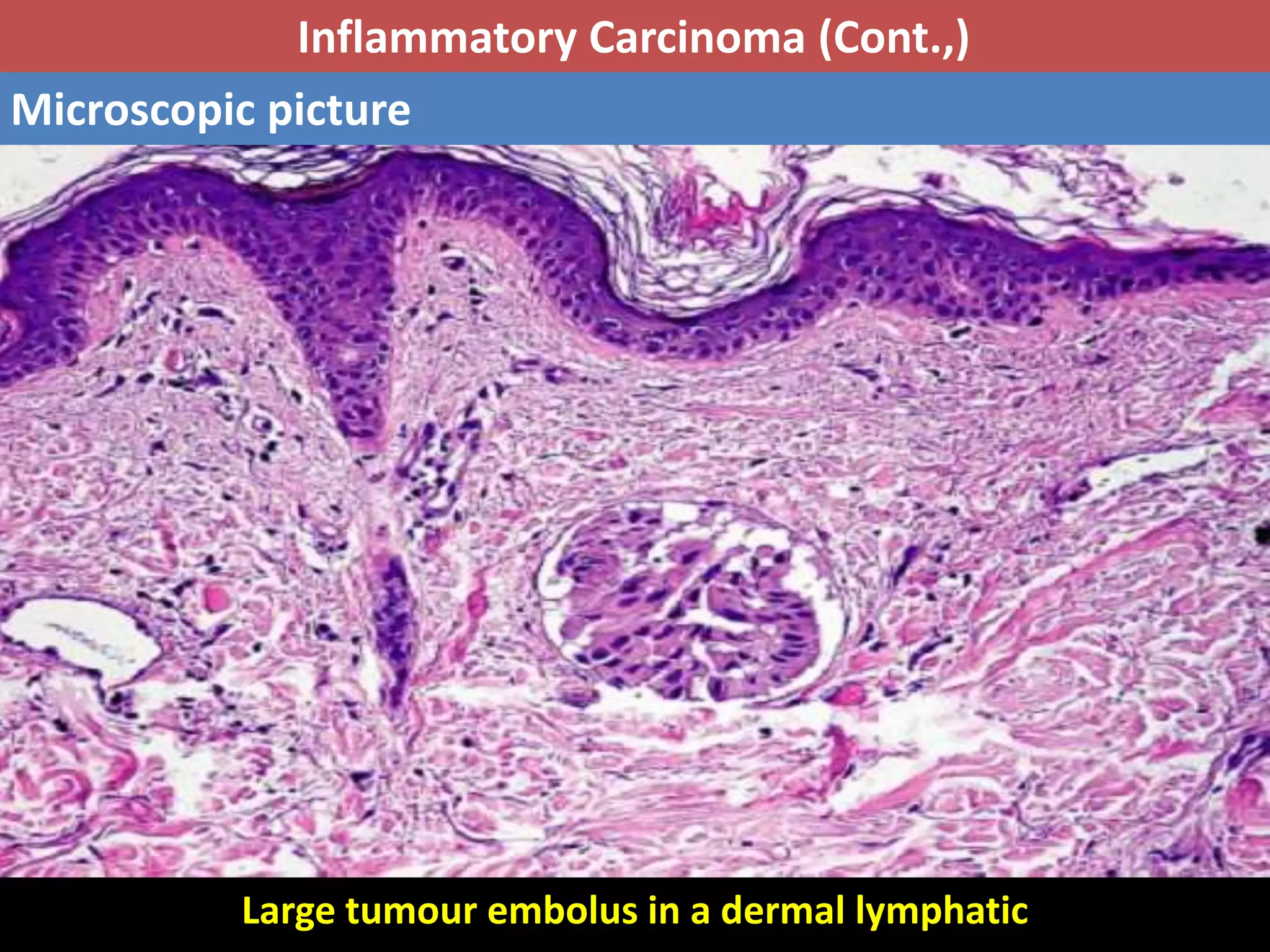 Pathology of breast cancer | PPTX