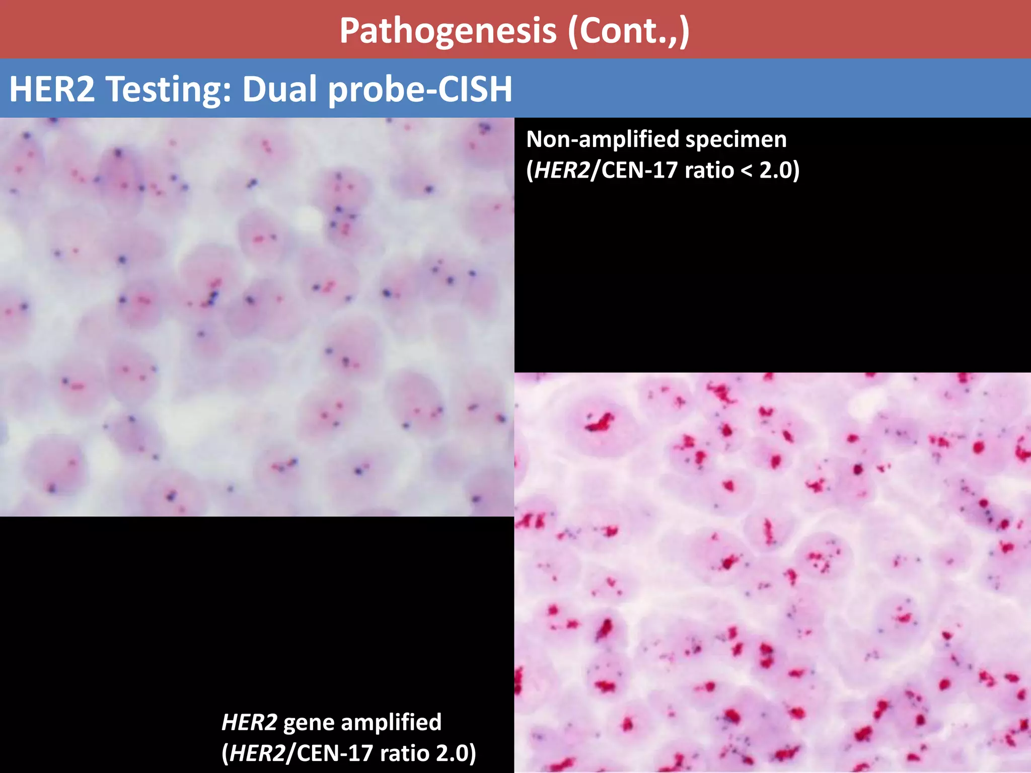 Pathology of breast cancer | PPTX