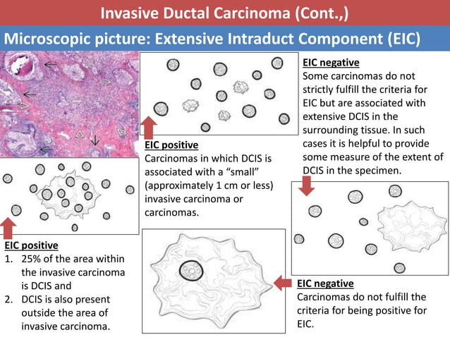 Pathology of breast cancer | PPTX