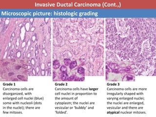 Pathology of breast cancer | PPTX