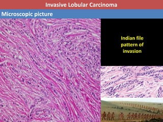 Pathology of breast cancer | PPTX