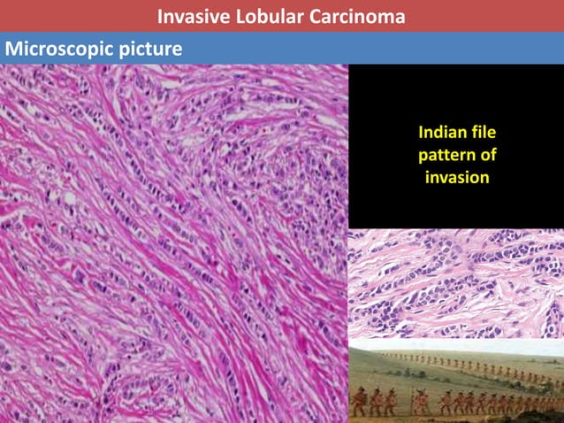 Pathology of breast cancer | PPTX