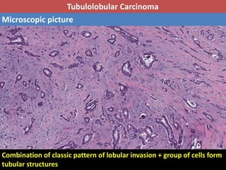 Pathology of breast cancer | PPTX