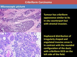 Pathology of breast cancer | PPTX